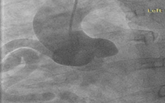 A Case Report of The Adult Asymptomatic Alcapa Syndrome | Biores Scientia